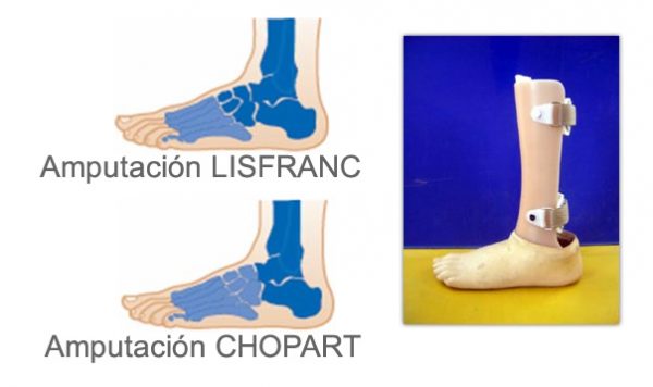 Prótesis de miembro inferior | OrtePRO