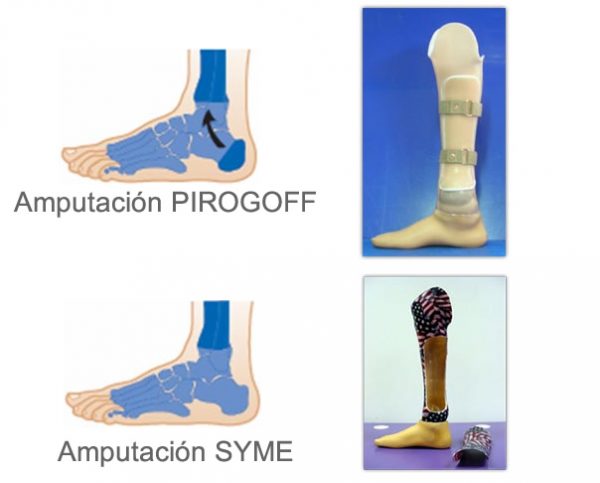 Prótesis de miembro inferior | OrtePRO
